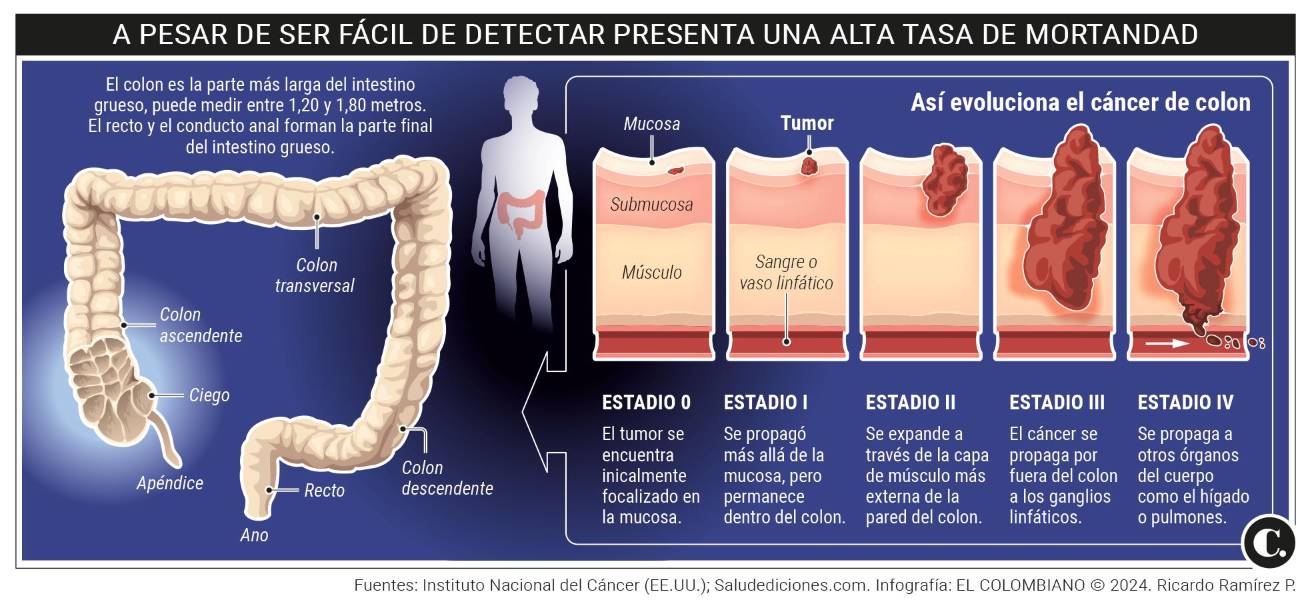 Así avanza el cáncer de colon, la enfermedad que afronta Rodolfo Hernández