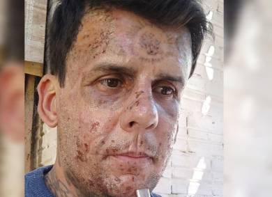 Imágenes sensibles | El hombre más tatuado de Brasil decidió quitarse ...