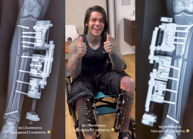 Video: Yeferson Cossio mostró nuevos avances de su cirugía de ...