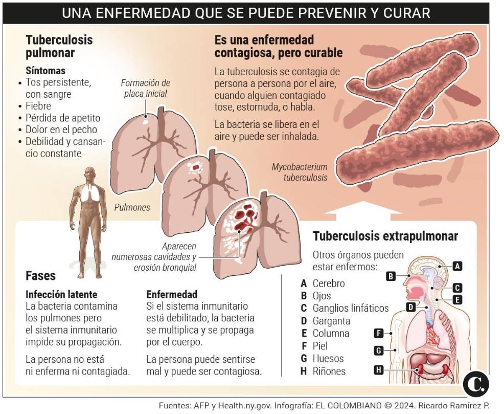 Infografía: entienda cómo se contagia la tuberculosis y de qué manera identificar sus síntomas