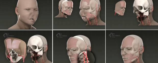 Médicos españoles realizaron el primer trasplante de cara completo